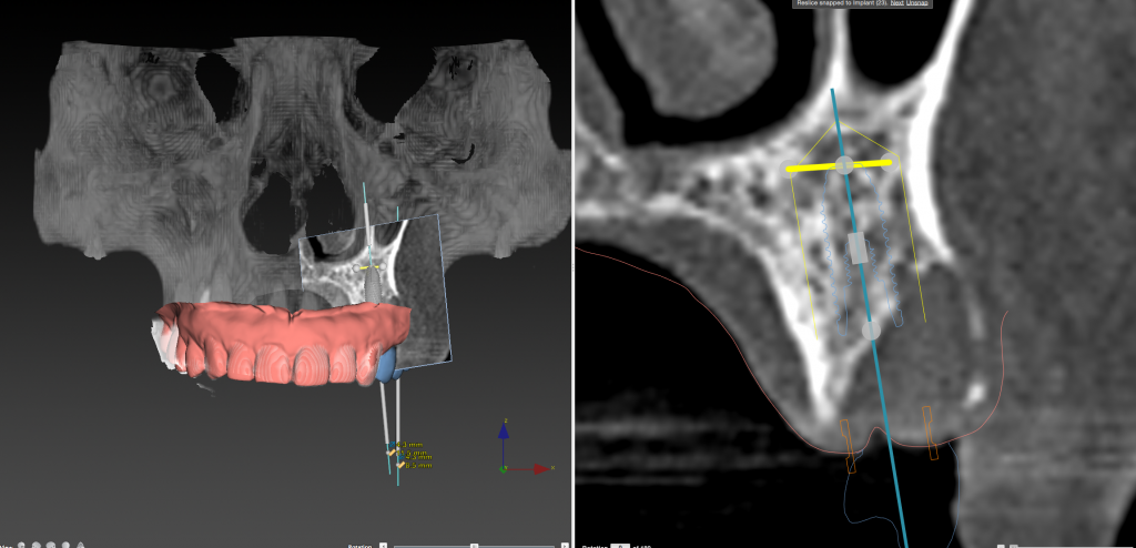 Implant placement simulation - 新川崎駅のインプラント・審美歯科・矯正なら「新川崎歯科医院」